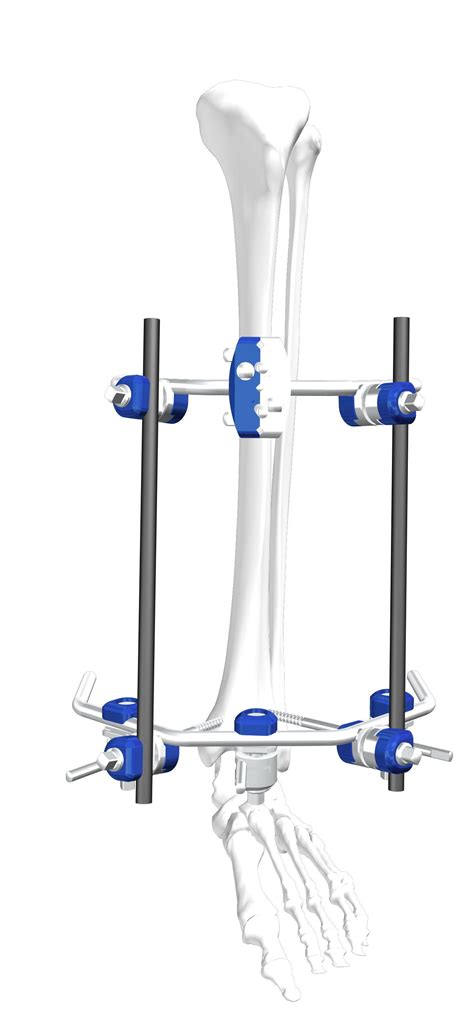 Orthopedic Trauma Implant Medical Device Dissection IV Φ 8 Distal Tibia External Fixation