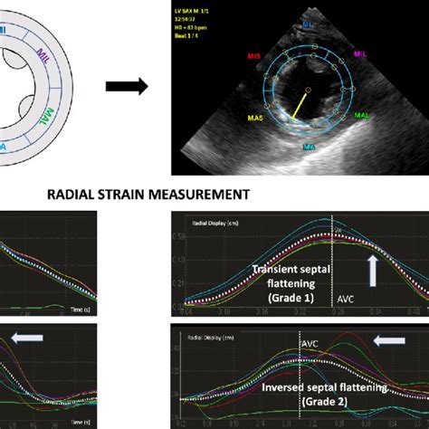 Schematic Representation Of Left Ventricular Segmentation For Strain Download Scientific