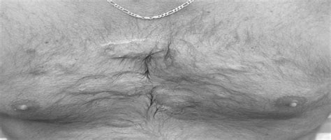 Nodular Scleroderma A Report Of 2 Cases The American Journal Of Dermatopathology