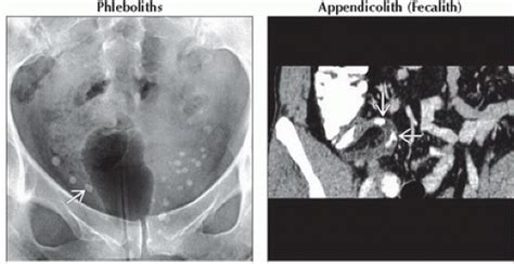 Da1 Db1 Abdominal Calcifications Ffu8  Abdominal Key