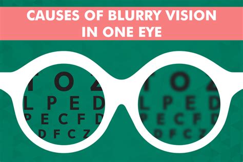 Blurry Vision In One Eye Know The Causes And Solutions