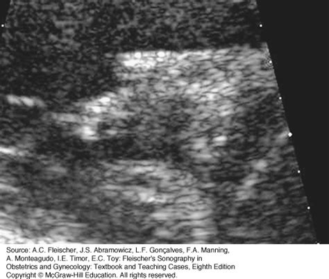 Prenatal Diagnosis Of Skeletal Anomalies Obgyn Key
