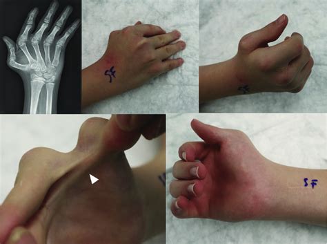 A Patient With Da And Wbhs Note The Ulnar Finger Deviation In The Download Scientific Diagram