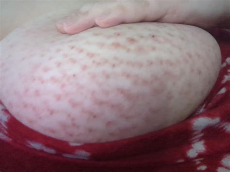 Help What Medication Can I Put On This Area To Help Heal It R Skinpicking