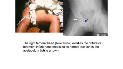 Dislocation Of Different Joints Pptx
