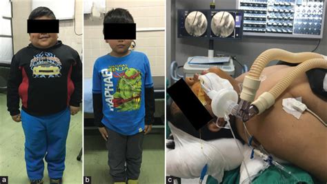 Neurosurgical Aspects And Clinical Outcomes On The Treatment Of Cushing