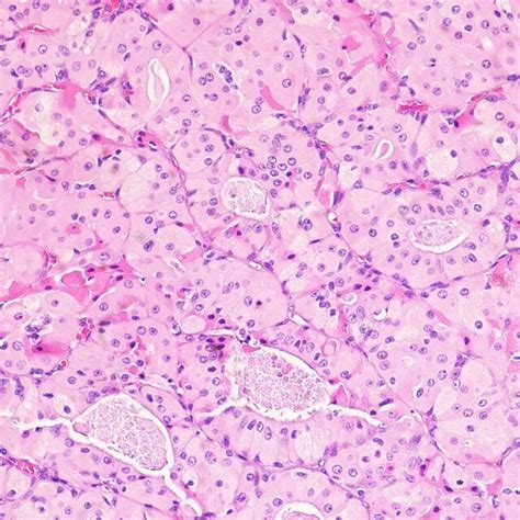 Cell Block From Fna Of Left Parotid Gland Showing Clusters Of Oncocytes