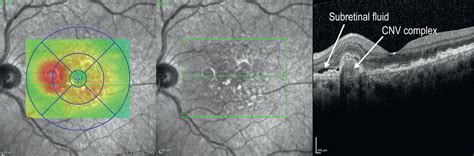 Wet Age Related Macular Degeneration Clinical Tree