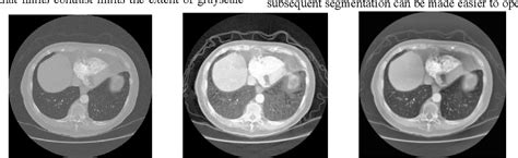 Figure 1 From Classification Of Pulmonary Nodules By Using Improved