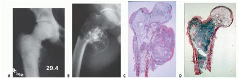 Proximal And Total Femur Resection With Endoprosthetic Reconstruction Oncohema Key