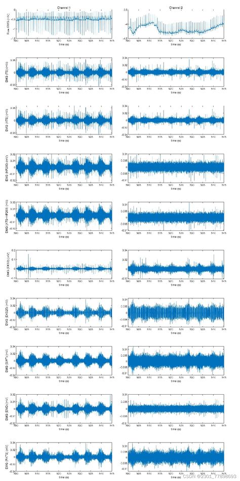 Matlab环境下emg信号降噪 执行matlab环境下emg信号降噪emg噪声 Csdn博客