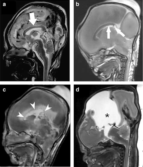 Sagittal T2 Wi Demonstrates The Differences In The Corpus Callosum