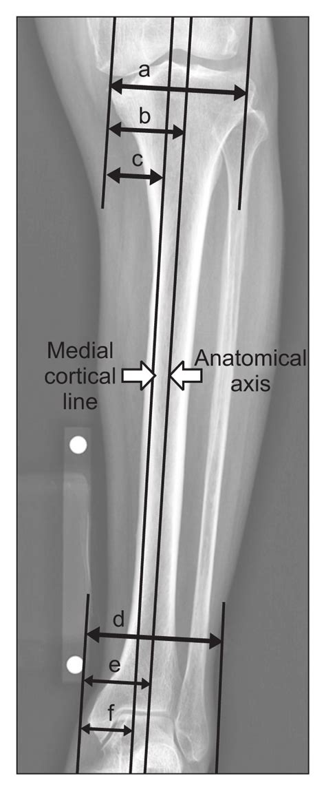 Extramedullary Tibial Bone Cutting Using Medial Cortical Line In Total Knee Arthroplasty