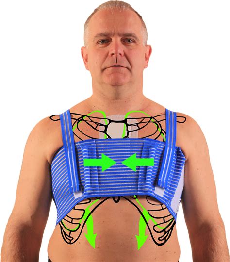 After Open Heart Surgery The Sternum Is A Fractured Bone Is It Treat