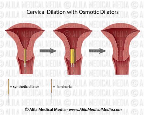 Laminaria Cervical Dilator