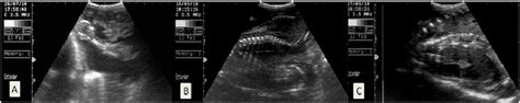 Typical Images Observed By Transabdominal Real Time Ultrasonography Download Scientific Diagram