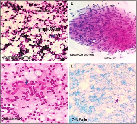 Cytology Smears Of Ascitic Fluid Supraclavicular Lymph Node And Liver