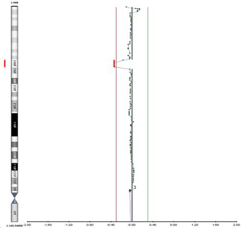 Array Cgh Analysis Illustrating In Depth The De Novo Interstitial