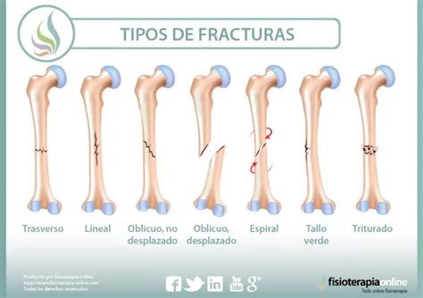Fracturas óseas, tipos, cuidados y tratamiento | Medicina de urgencias ...