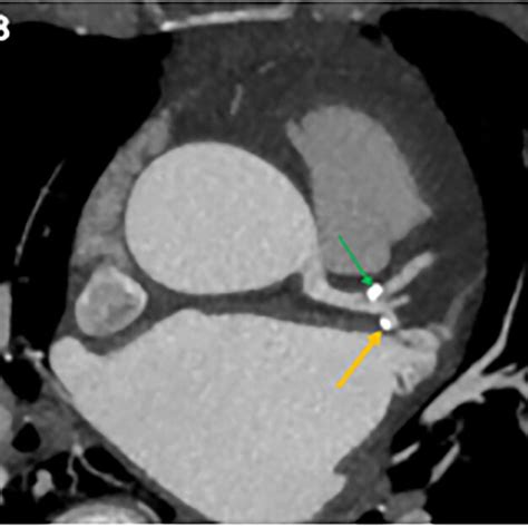 Plaque Distribution Lm Plaque Red Arrow Lad Proximal Segment Plaque Download Scientific