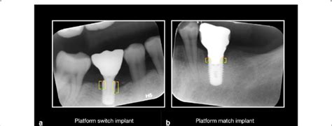 Keypoints For Marginal Bone Loss Assessment A Platform Switch