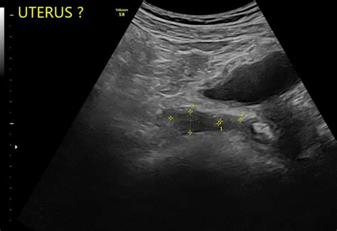 Does Anyone Have An Idea If This Is A Uturus R Intersex