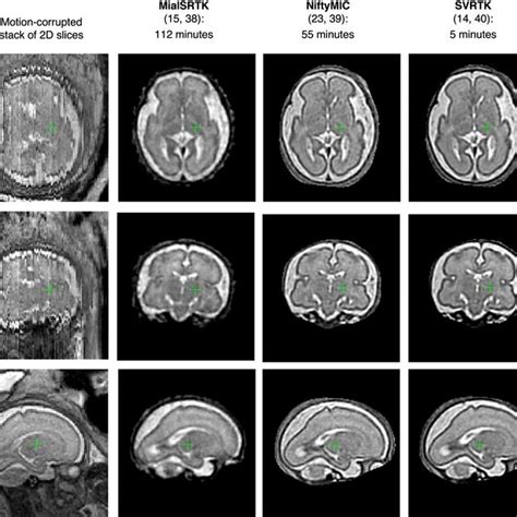 Comparison Of Different Svr Reconstruction Toolboxes For Foetal Brain