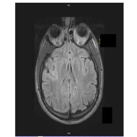Ictal Scalp Eeg A Left Temporal Seizure Pattern Appeared Up To 50 S