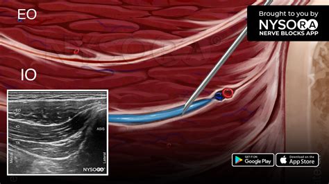 Nerve Block Tip Of The Week Anterior Tap Block Nysora