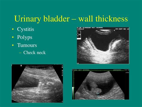 Thickening Of Bladder Wall