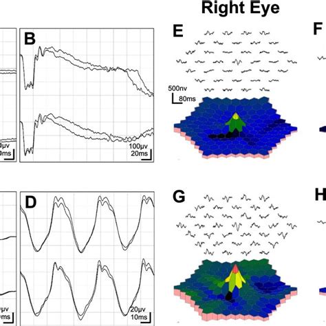 Full Field Electroretinogram Waveforms Obtained 3 Months After The Download Scientific Diagram