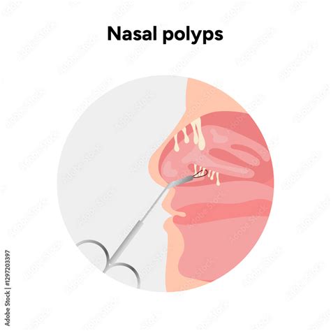Nasal Polyps Nose Disease Diagnostic And Treatment Medical Diagram