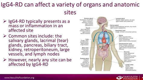 Igg4 Related Disease Youtube