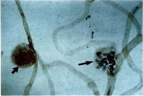 Trypsin Digest Preparation Of Human Diabetic Retina Showing Acellular Download Scientific