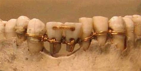 Arqueólogos Descubren Dentaduras Postizas Medievales Hechas Con Dientes