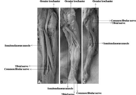 Bifurcation Level Of The Sciatic Nerve To Its Terminal Branches With Download Scientific