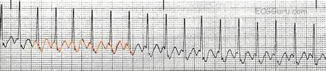 ECG Basics Atrial Flutter With Conduction Ratio Rhythm Strip ECG Guru Instructor Resources