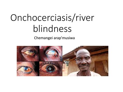 Onchocerciasis Pptx