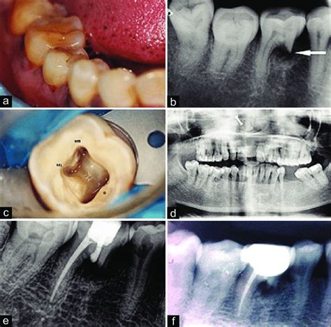 A Clinical Picture Of Tooth 46 Showing Attrition With Cervical Download Scientific Diagram