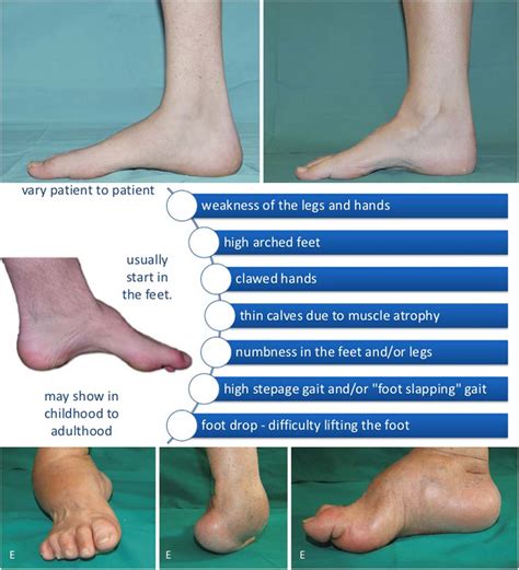 Cmt Disease Types Maladie De Charcot Marie Tooth Vyieml