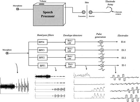 Sound Processors In Cochlear Implants Ento Key