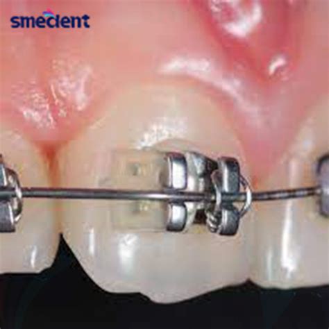How To Use Rotation Wedges In Orthodontics At Alice Denzer Blog