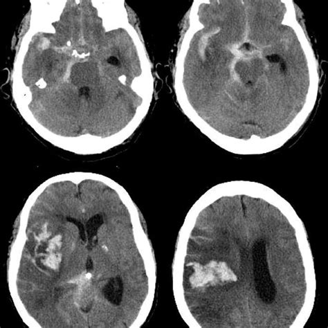Computed Tomography Revealed Diffuse Subarachnoid Hemorrhage Associated