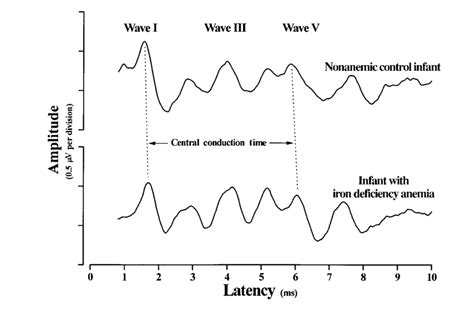 Representative Auditory Brainstem Responses At 6 Mo Recordings At 85 Download Scientific