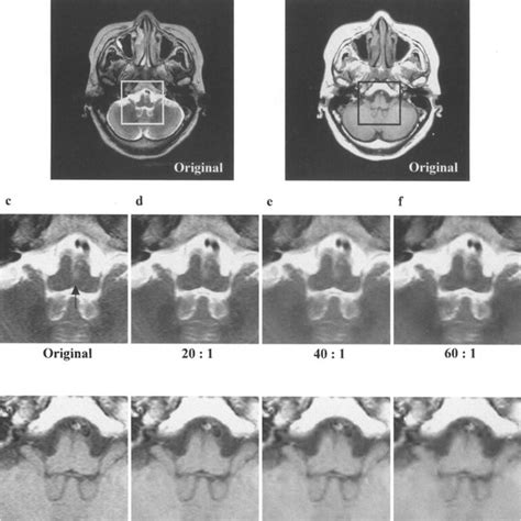 Detection Of Focal Brain Lesions At Mri With Wavelet Compression Download Table