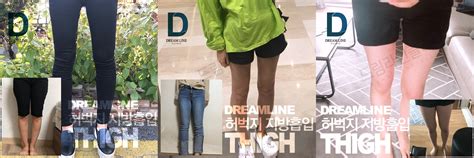 드림라인클리닉 예쁜 옷 입고싶은데 허벅지가 걸린다면😱😭 뭘 입어도 국보급 각선미 드림라인 허벅지
