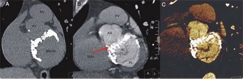 Multiplanar Reconstruction Of Cardiac Computed Tomography Scan