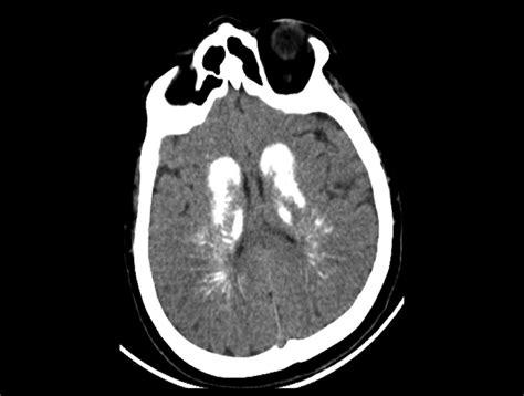 Bilateral Diffuse Symmetrical Areas Of Calcification In The Download Scientific Diagram