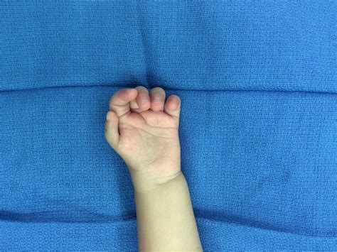 Pollicization Concerns Immediately After Surgery Congenital Hand And Arm Differences
