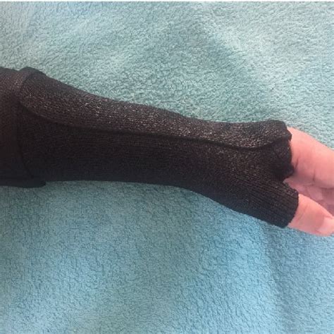 pdf analyzing the functional effects of dynamic and static splints